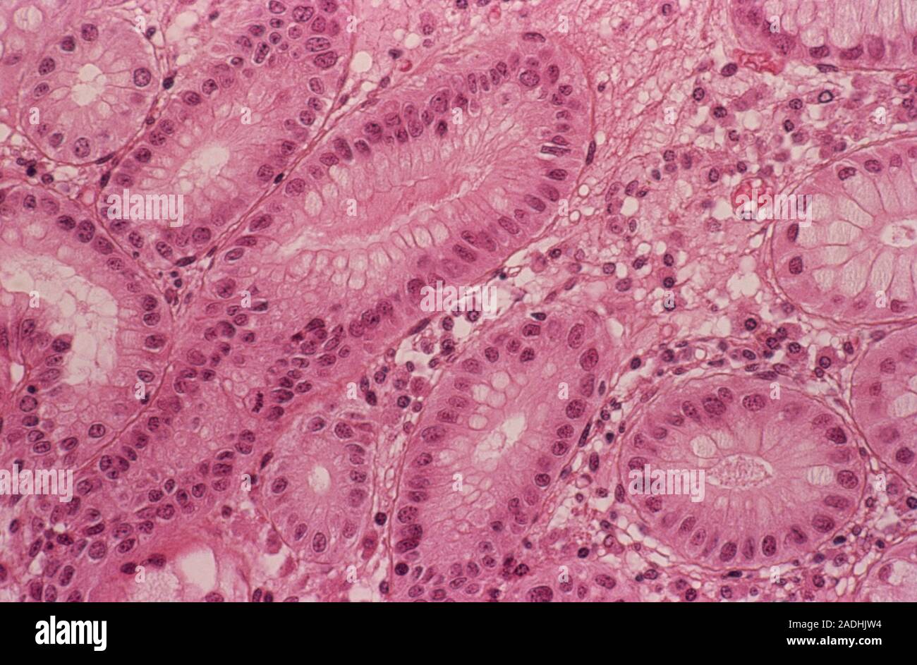 Stomach metaplasia. Light micrograph of a section through tissue from ...