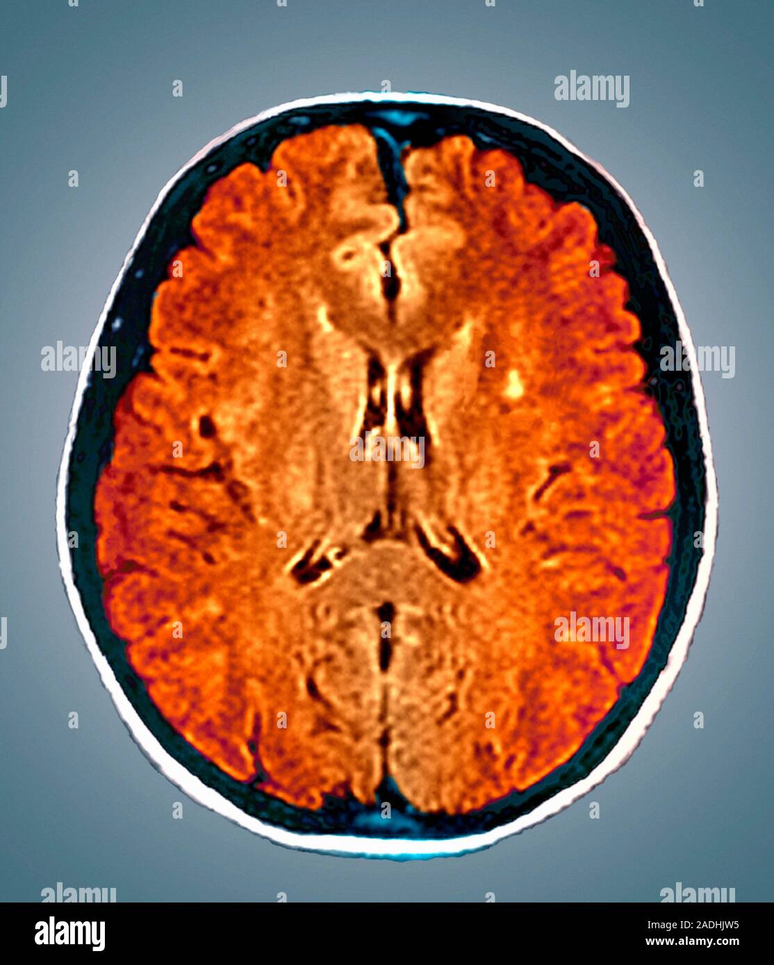 Multiple sclerosis. Coloured magnetic resonance imaging (MRI) scan of an axial section through ...