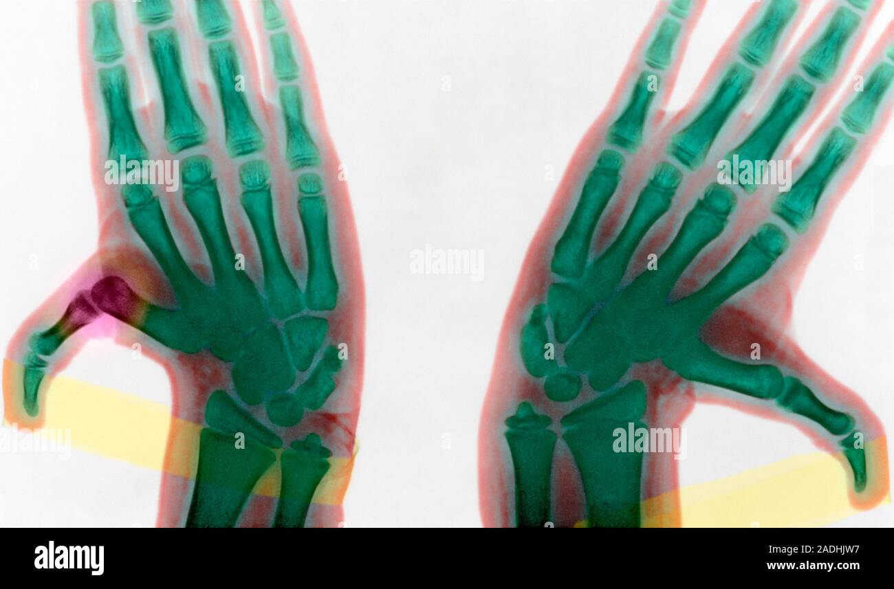 Marfan's syndrome. Coloured X-ray of the hands of a patient with Marfan ...
