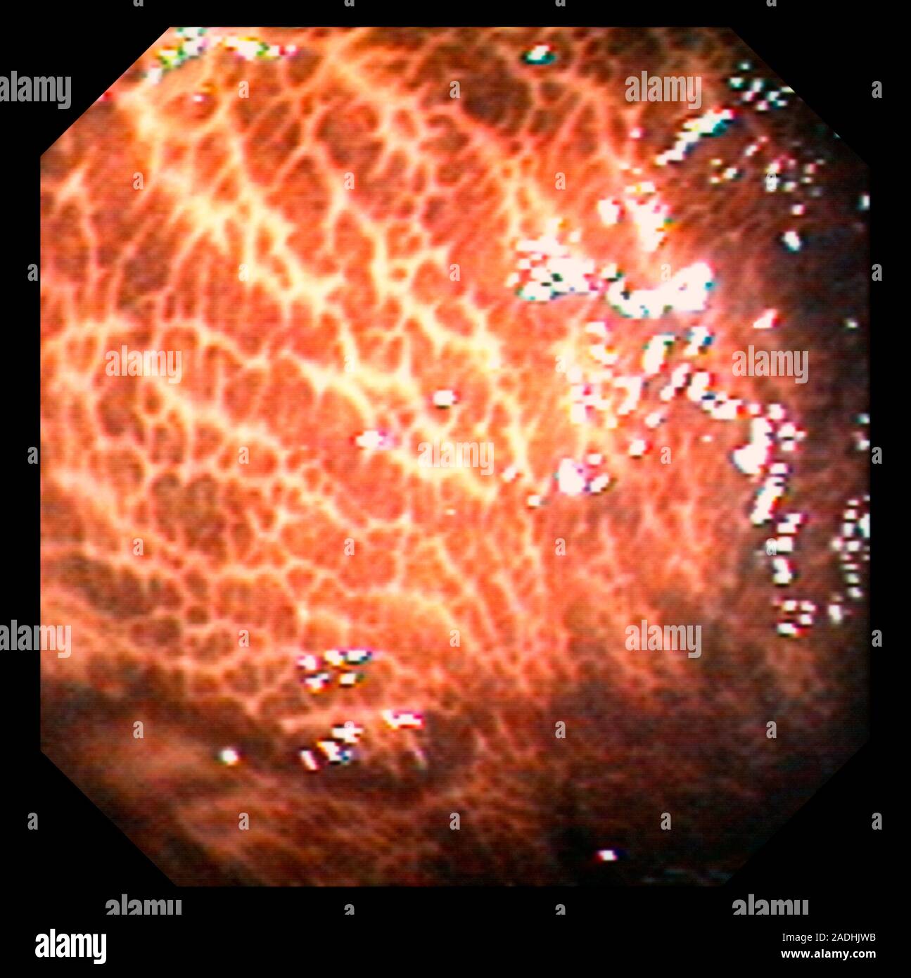 Stained colon. Colonoscope (endoscope) view of the darkly stained ...