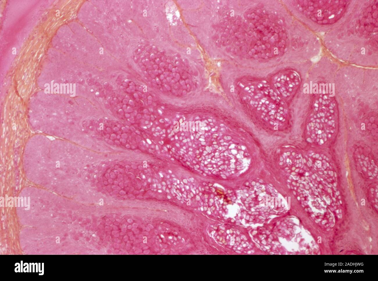 Molluscum contagiosum. Light micrograph of a section through the ...