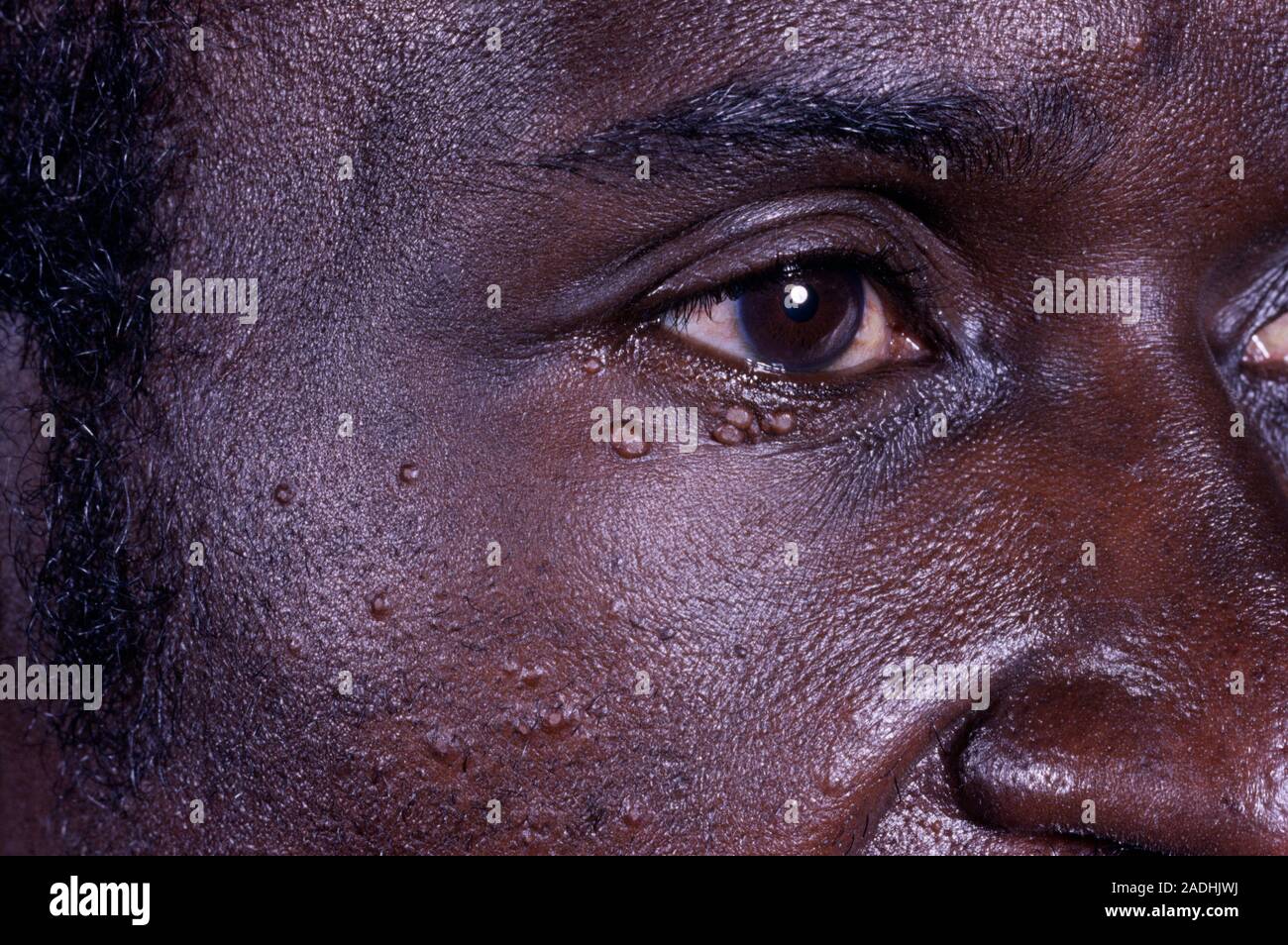 Molluscum contagiosum. Lesions on the skin of an adult male patient ...