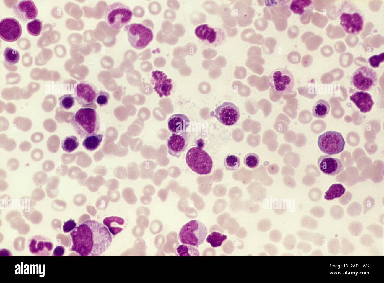 Malaria parasites. Light micrograph of red blood cells infected with ...