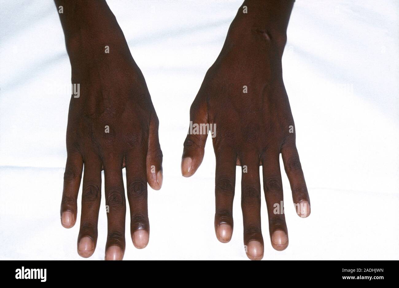 Marfan's syndrome. Hands of a patient with Marfan's syndrome, showing ...