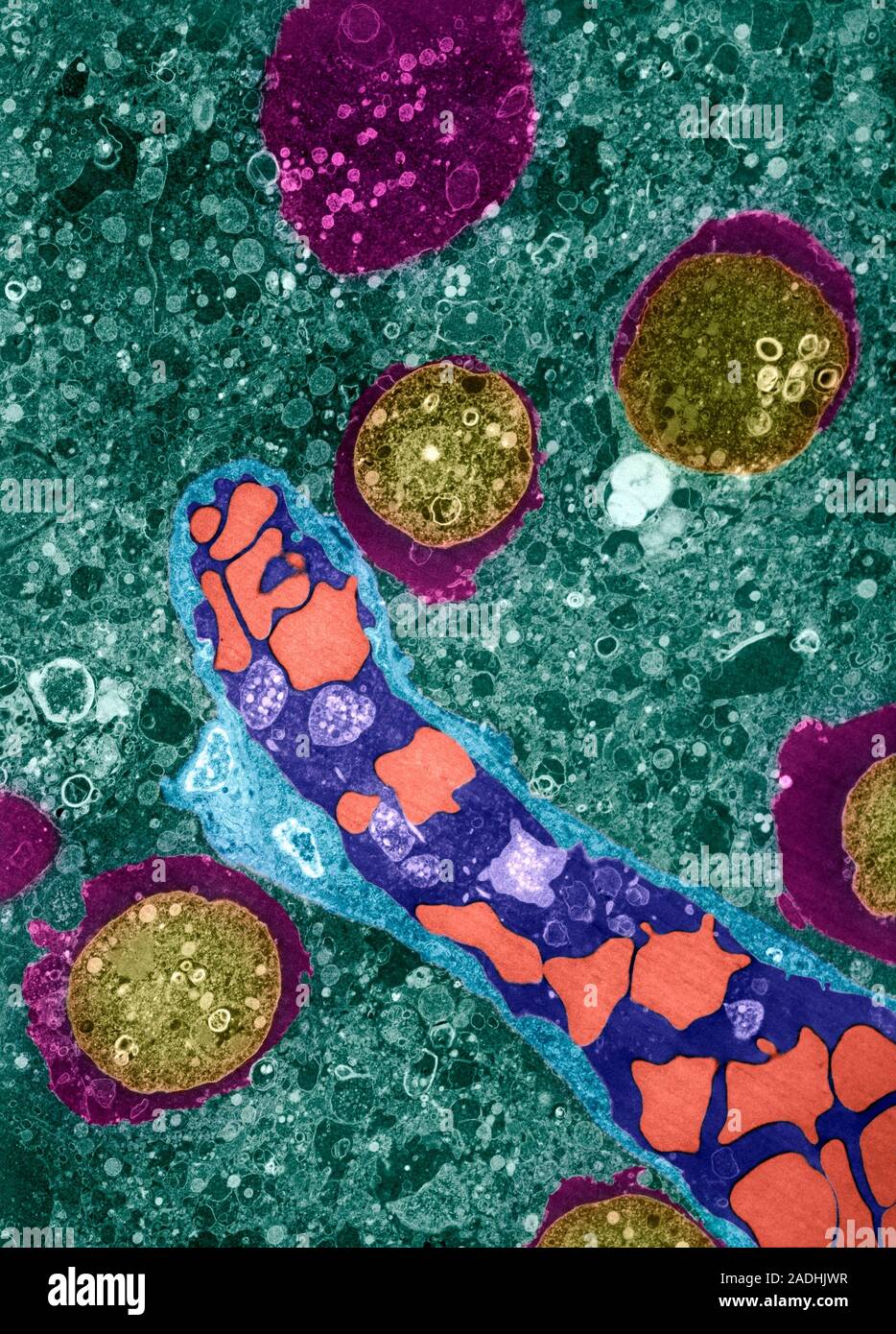 Brain inflammation (meningoencephalitis). Coloured transmission ...