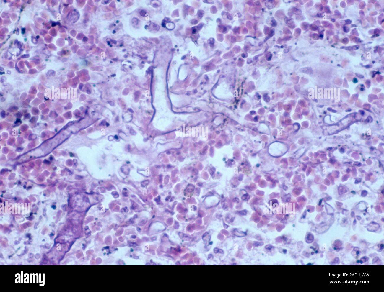 Mucormycosis infection. Light micrograph of a section through lung ...