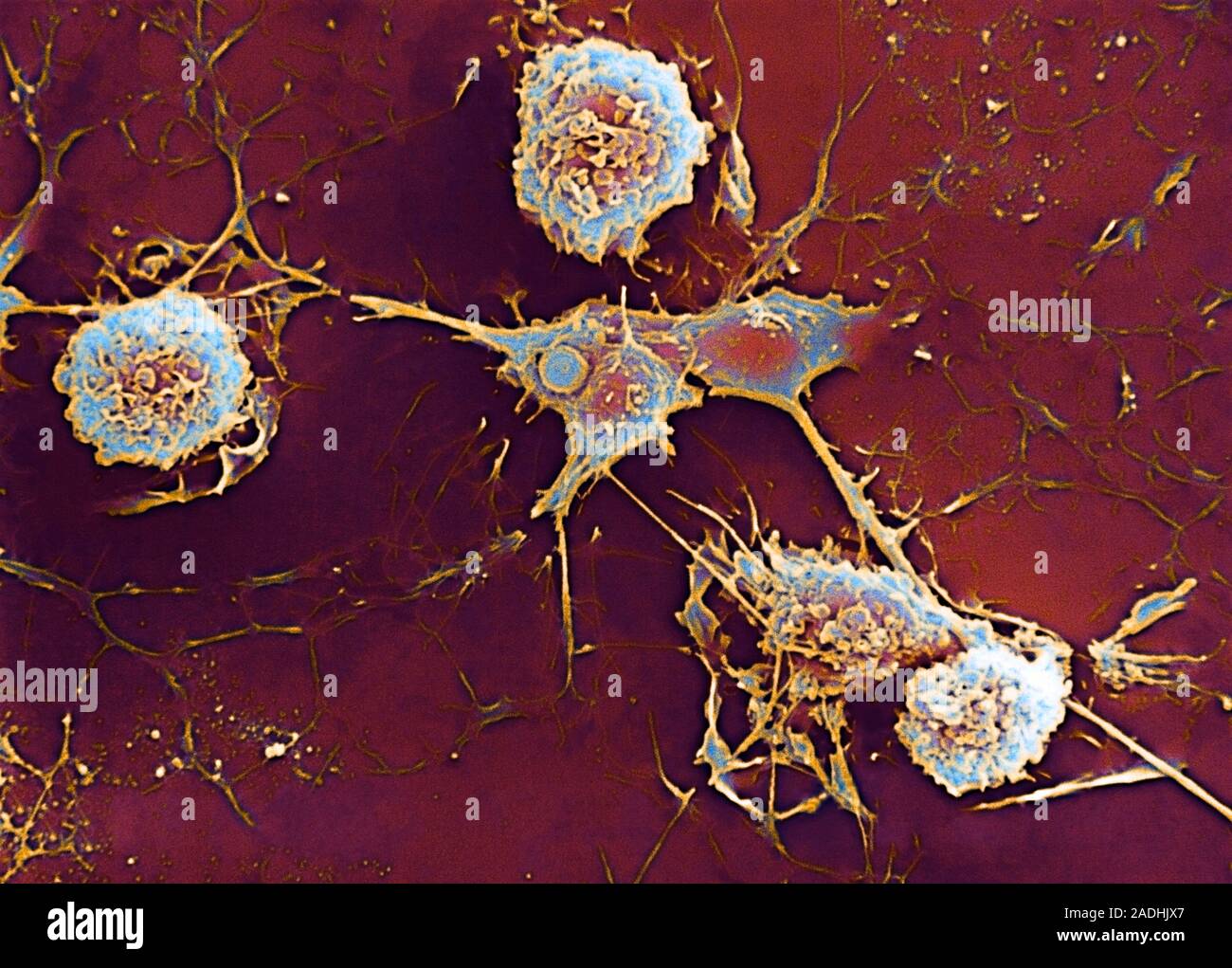 Multiple sclerosis. Coloured scanning electron micrograph (SEM) of ...