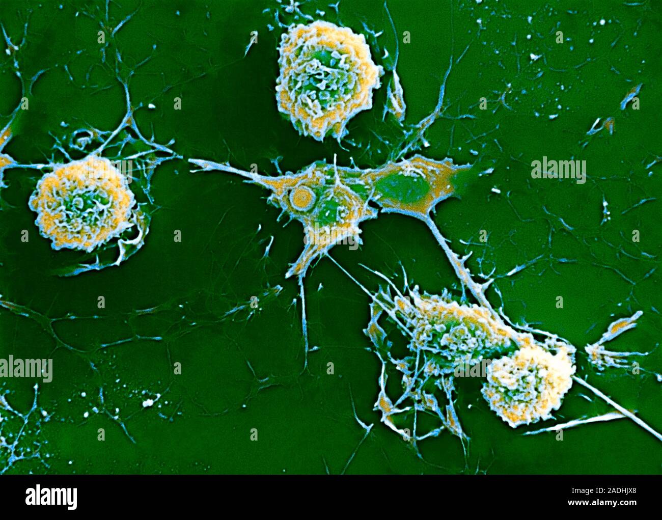Multiple sclerosis. Coloured scanning electron micrograph (SEM) of ...