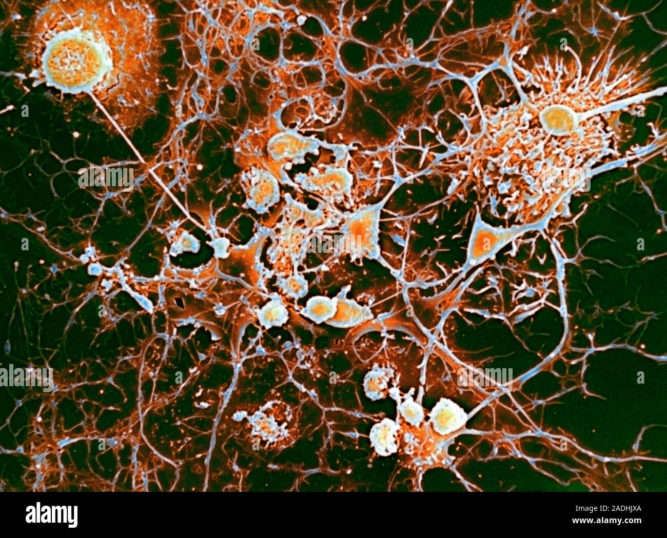 Multiple sclerosis. Coloured scanning electron micrograph (SEM) of ...