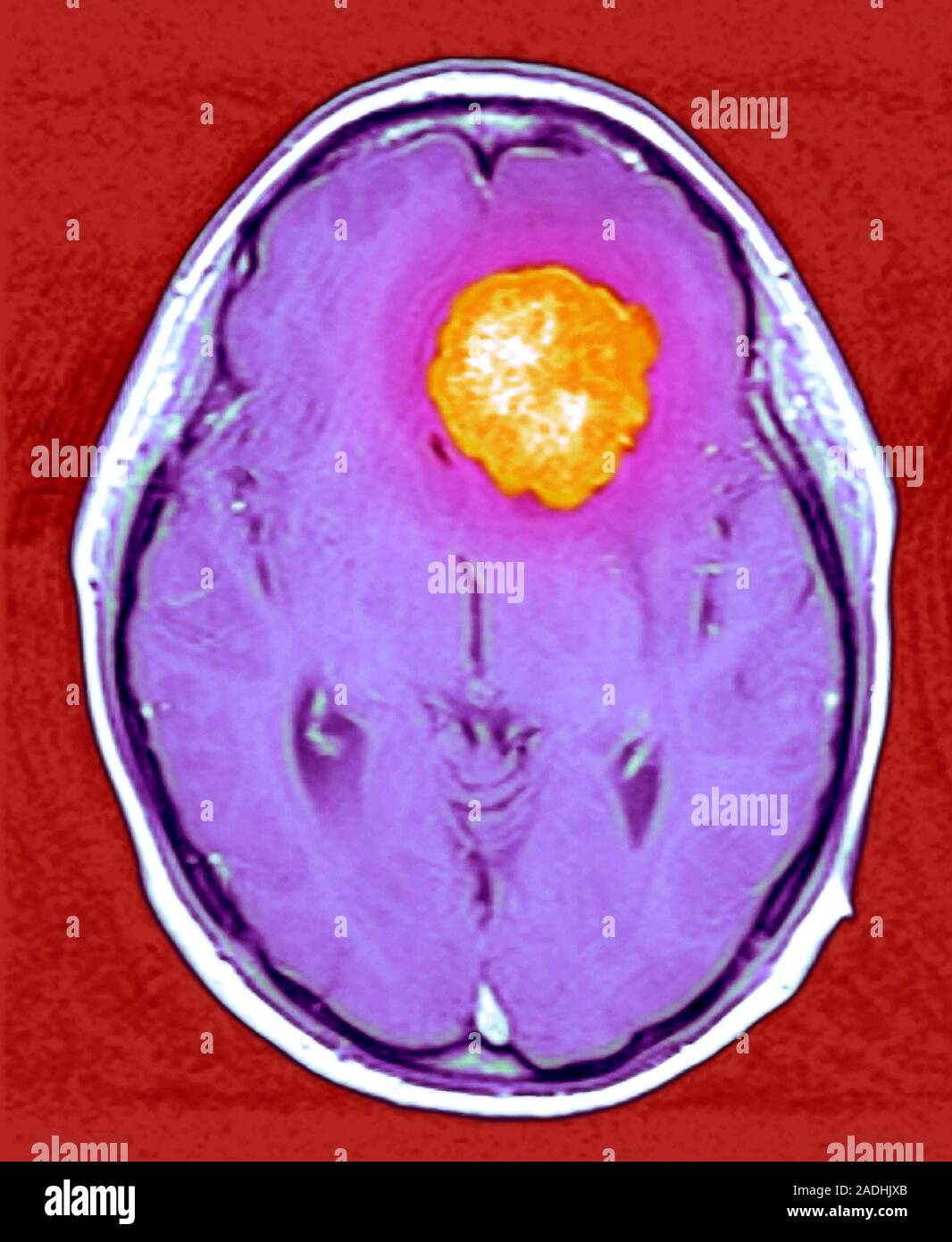 Brain tumour. Coloured magnetic resonance imaging (MRI) scan of an axial (horizontal) section ...