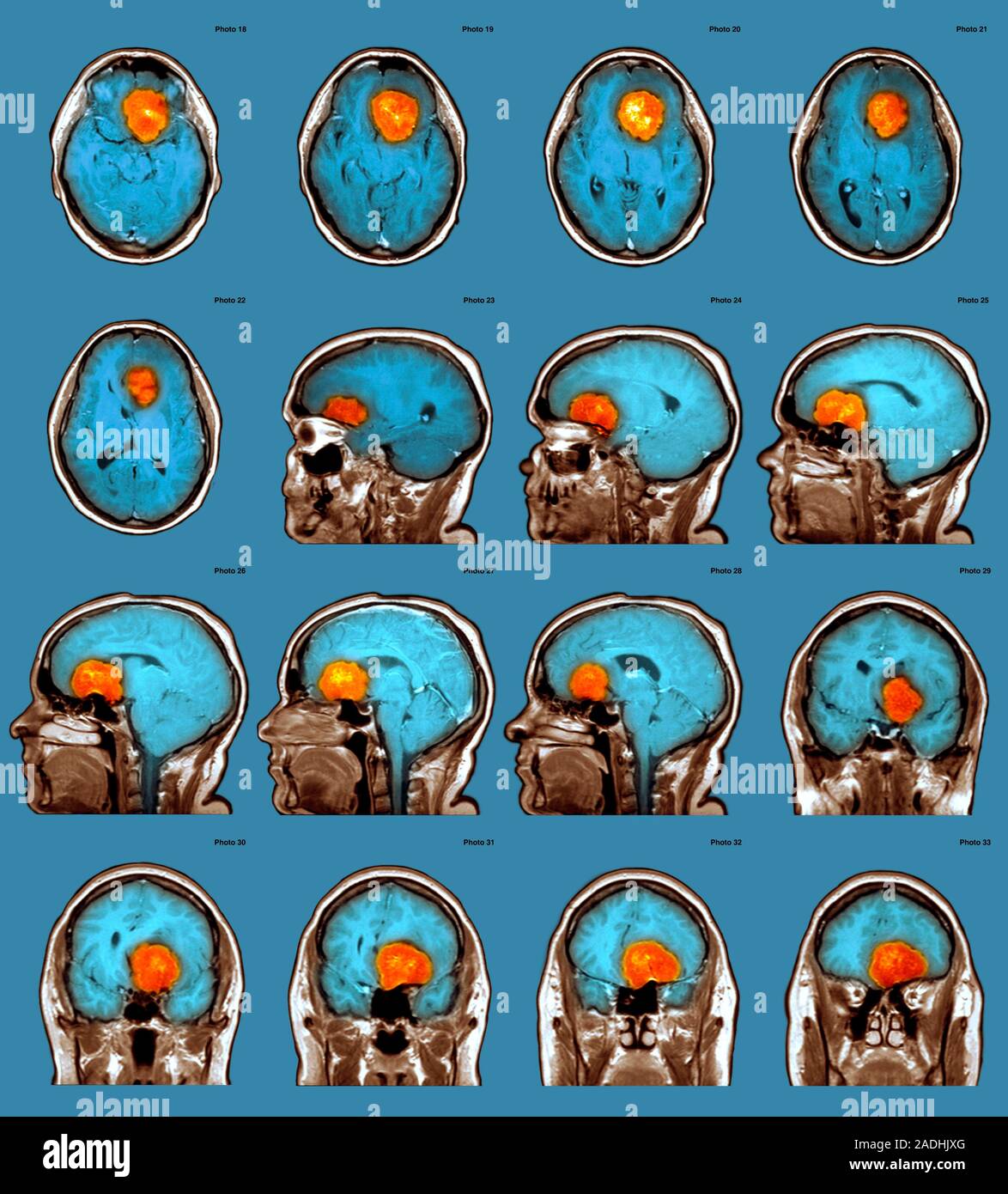 Brain tumour. Coloured magnetic resonance imaging (MRI) scans of sections through the brain of a ...