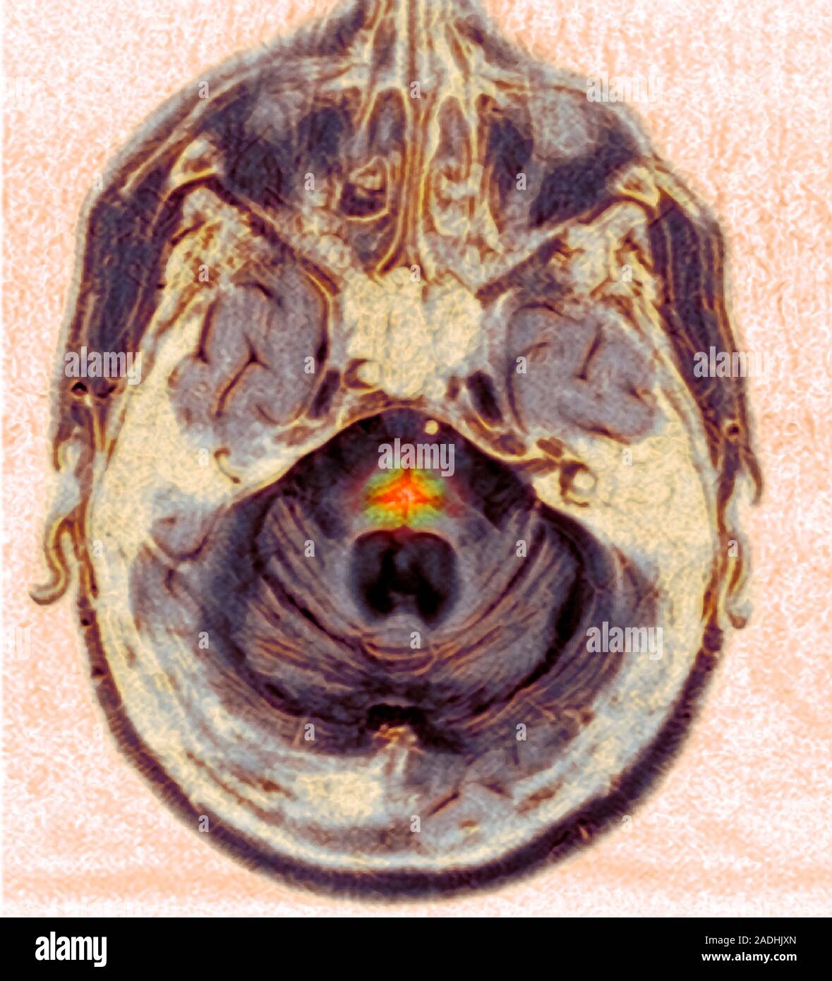 Multi-system atrophy. Coloured magnetic resonance imaging (MRI) scan of ...