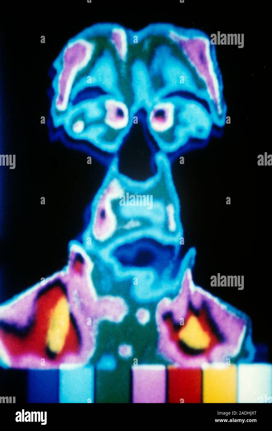 Before migraine. Image 1 of 3. Thermogram of the head (frontal view) of ...