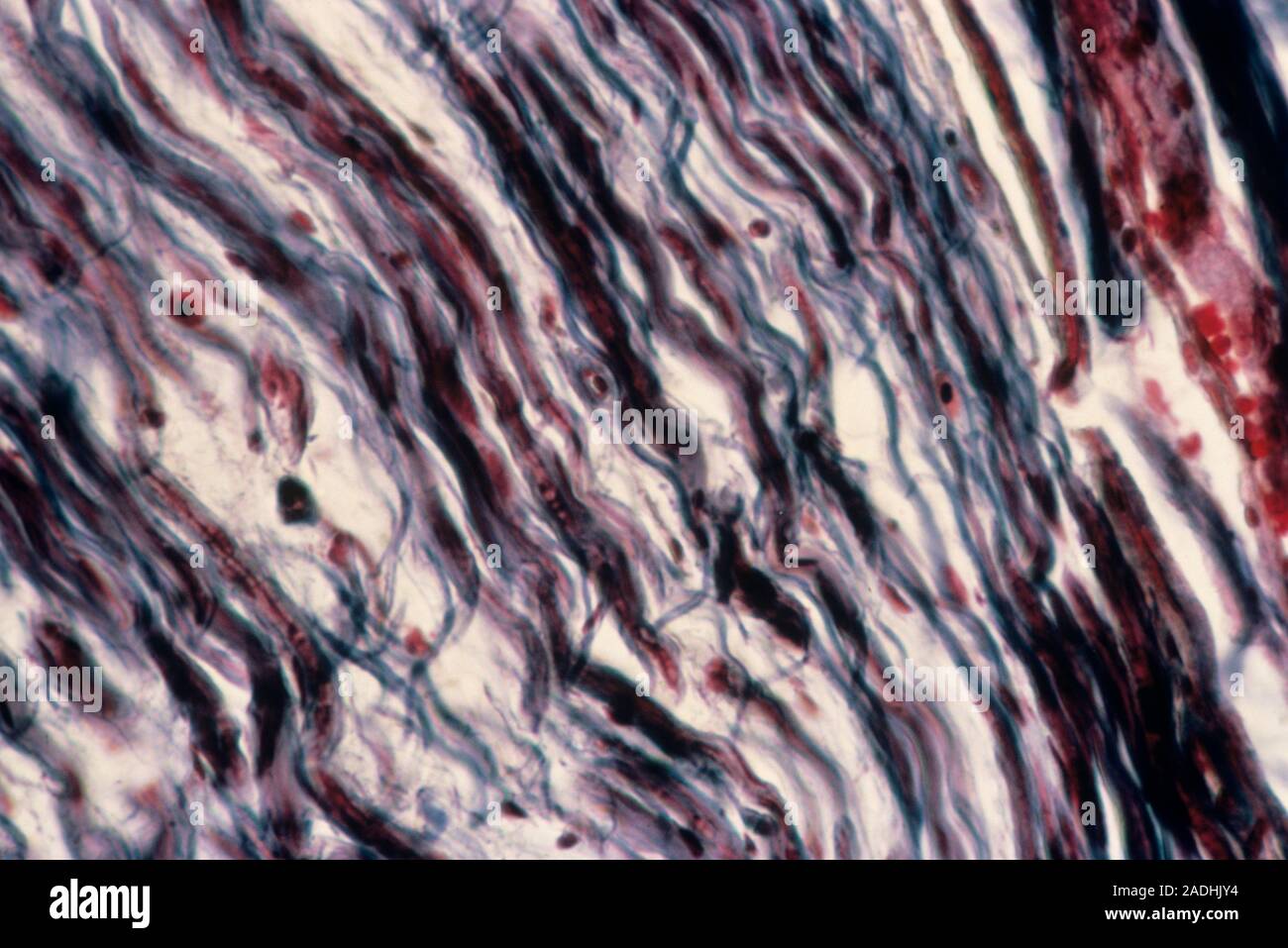 Multiple sclerosis. Light micrograph of nerve fibres showing ...