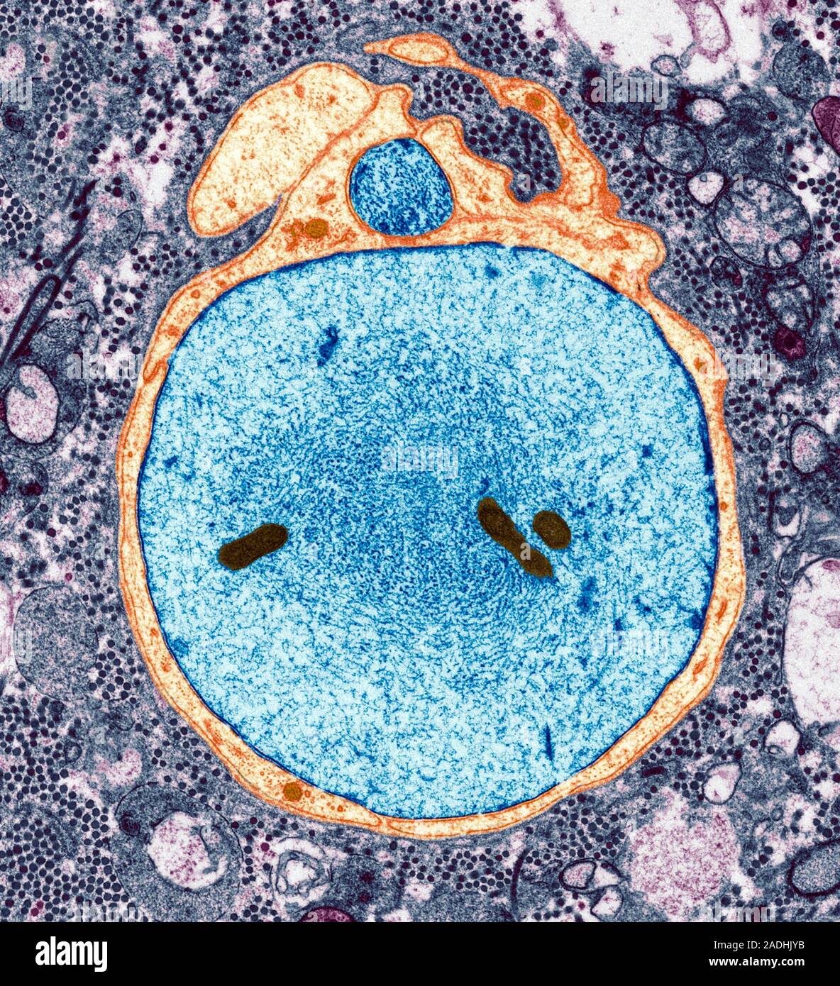 Demyelinated nerve in multiple sclerosis. Coloured transmission ...