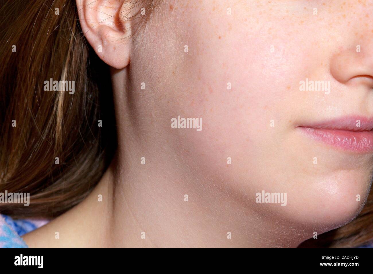 Mumps. Swollen glands in the cheek of a 22-year-old woman who has mumps ...
