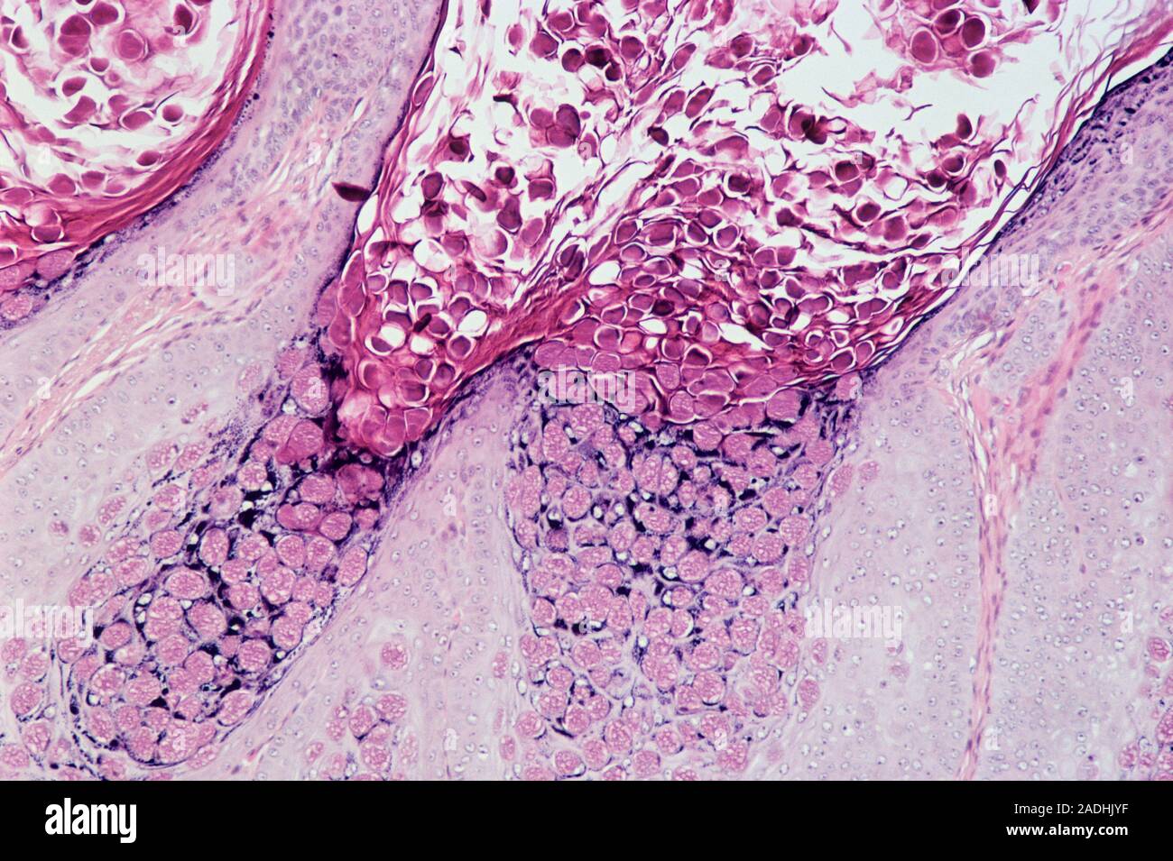 Molluscum contagiosum. Light micrograph of a section through human skin ...