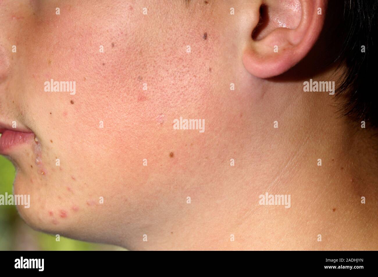 Mumps. Swollen gland of a 14 year old boy with mumps parotitis, a viral ...