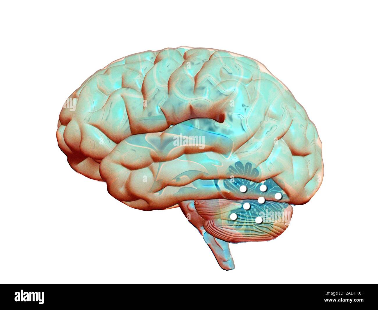 Multiple sclerosis. Computer artwork showing plaques (white) in the ...