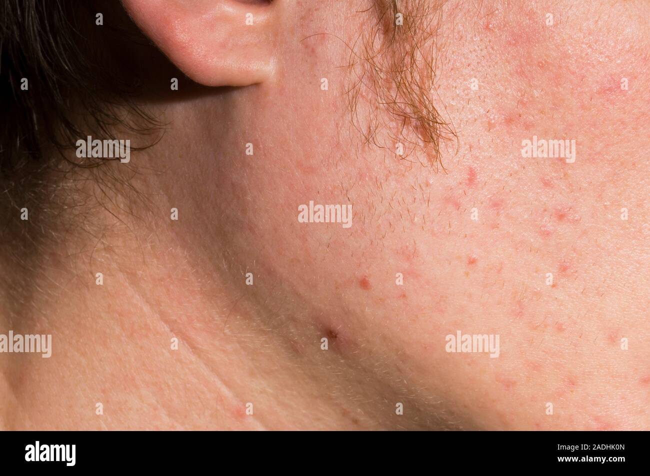 Swollen gland due to mumps, affecting a 22-year-old man's upper throat ...