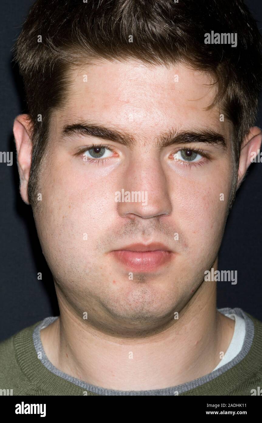 Mumps. Swollen gland (left) of a 21 year old man with mumps parotitis ...