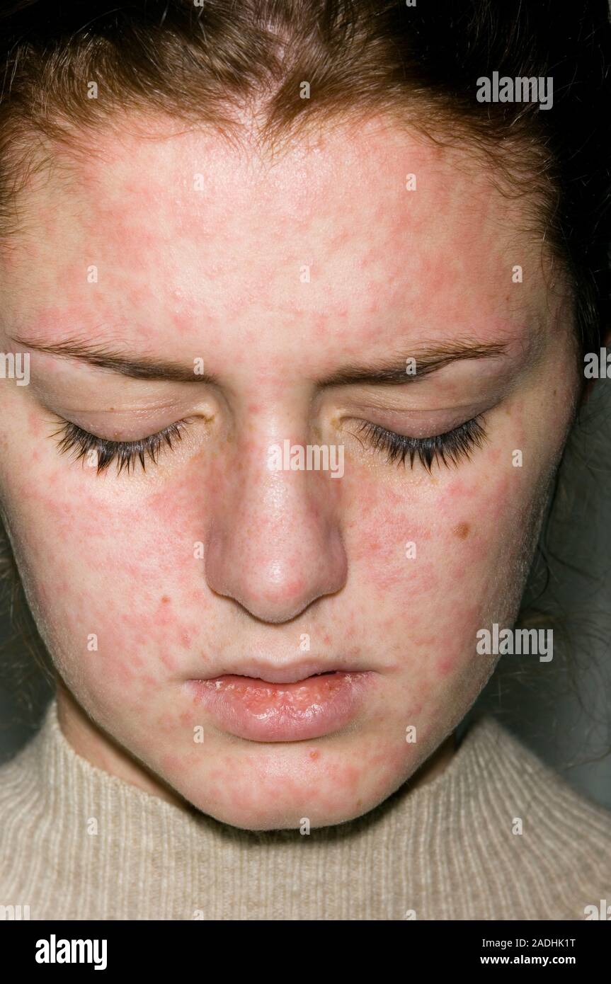 Measles rash on a 19 year old woman's face. Measles, also known as ...