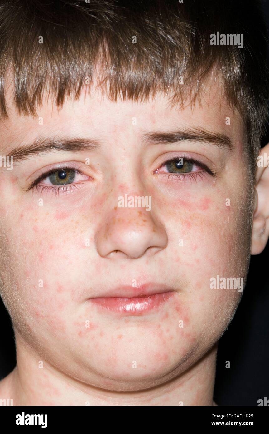 Measles rash on a 10 year old boy's face. Measles, also known as ...