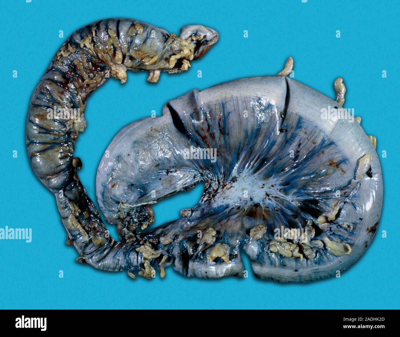 Megacolon. Gross specimen of a colon, part of which is seen to be ...