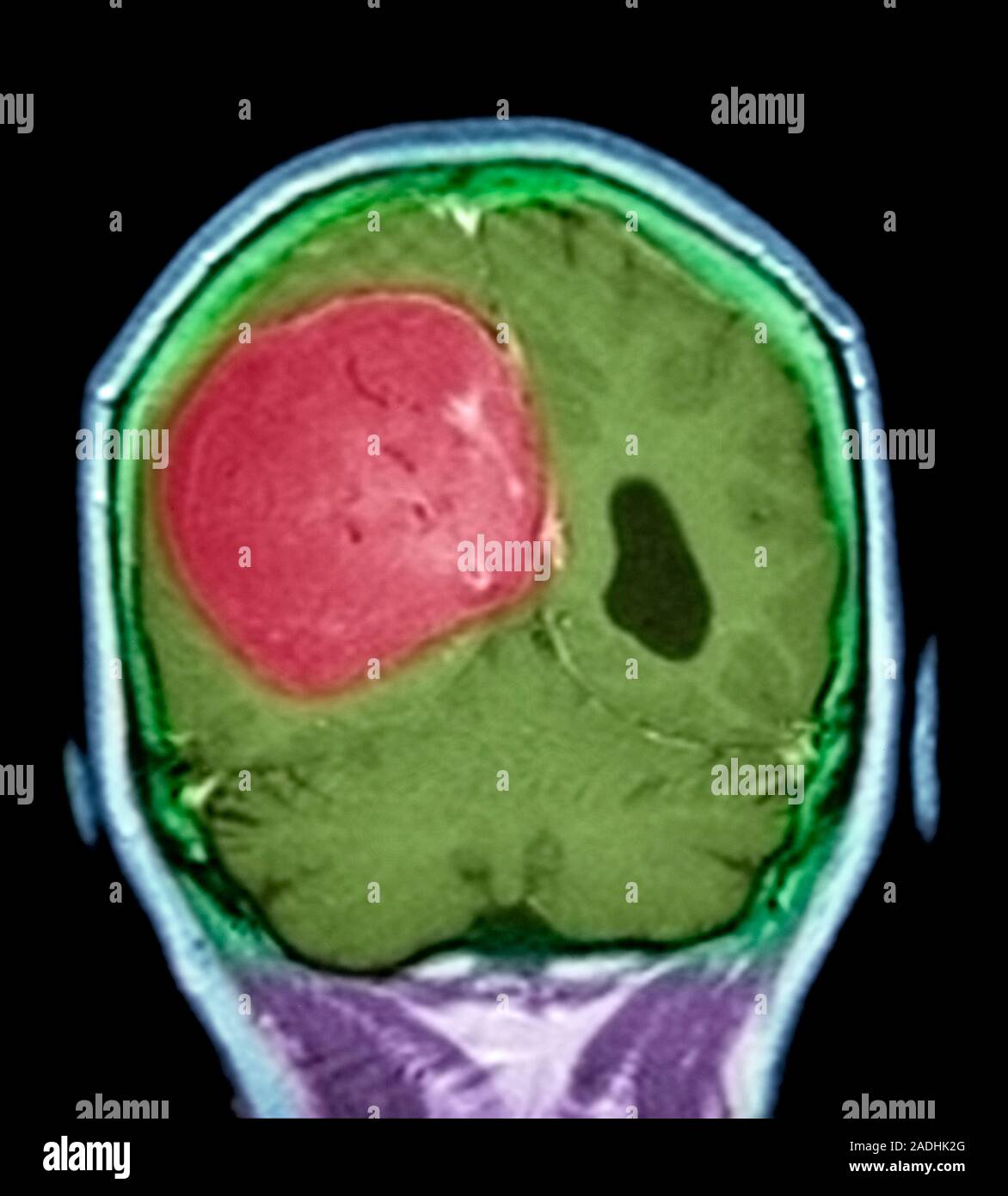Meningioma brain tumour. Coloured magnetic resonance imaging (MRI) scan of the head of a 60 year ...