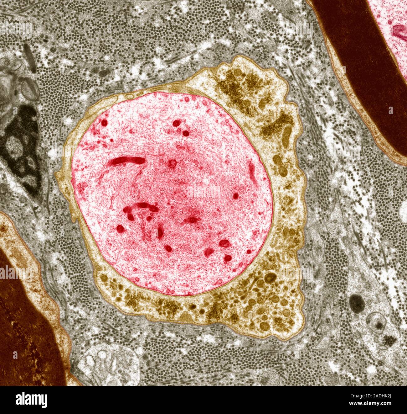 Demyelinated nerve. Coloured transmission electron micrograph (TEM) of ...