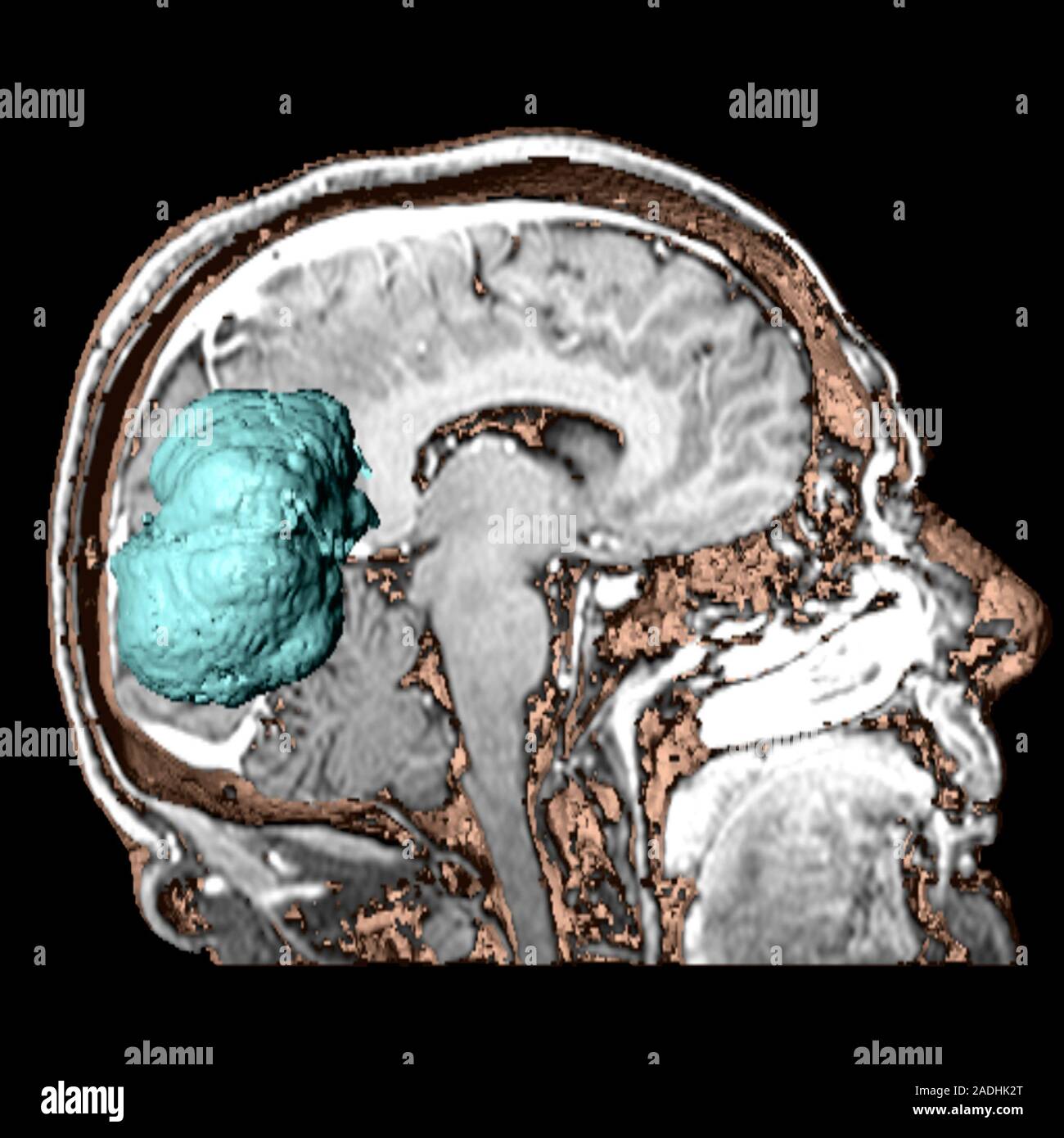 Brain tumour. 3D model of the head (side view) of a 59-year-old woman, made up from numerous MRI ...