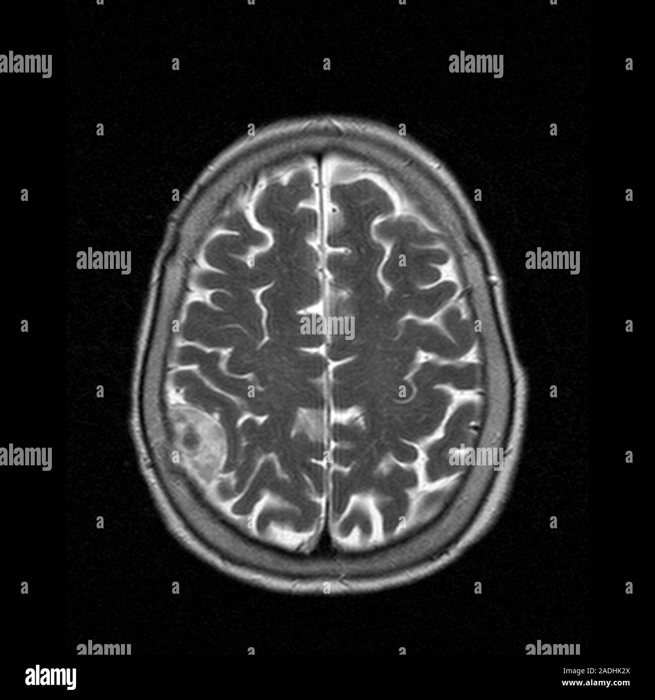 Meningioma tumour. Magnetic resonance imaging (MRI) scan of an axial ...