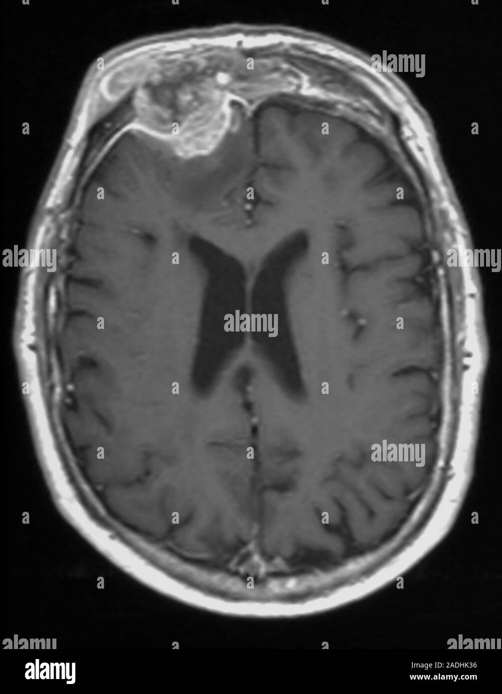 Mucocele growth. Magnetic resonance imaging (MRI) scan of an axial ...
