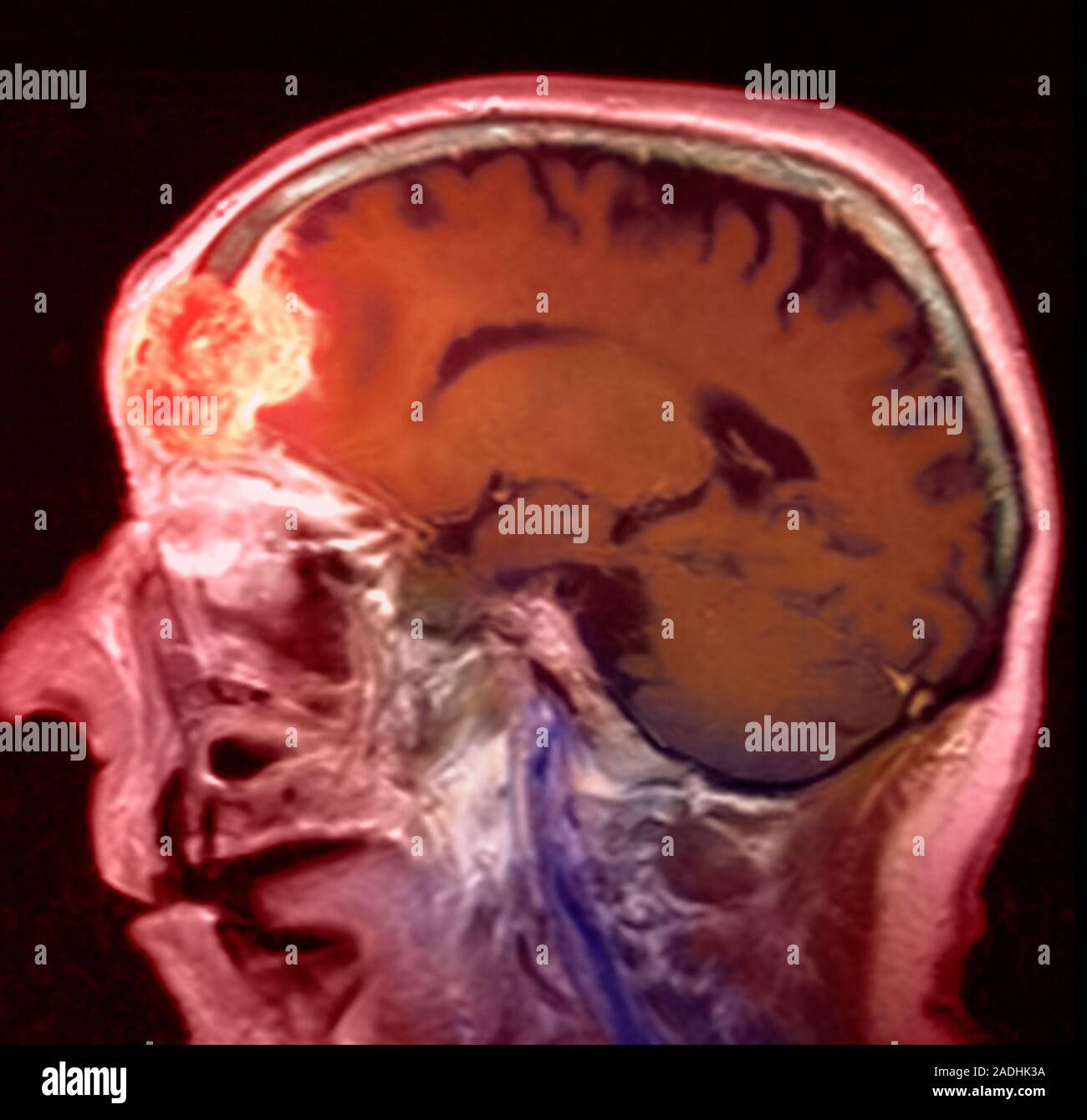 Mucocele growth. Coloured magnetic resonance imaging (MRI) scan of a sagittal (side) section ...