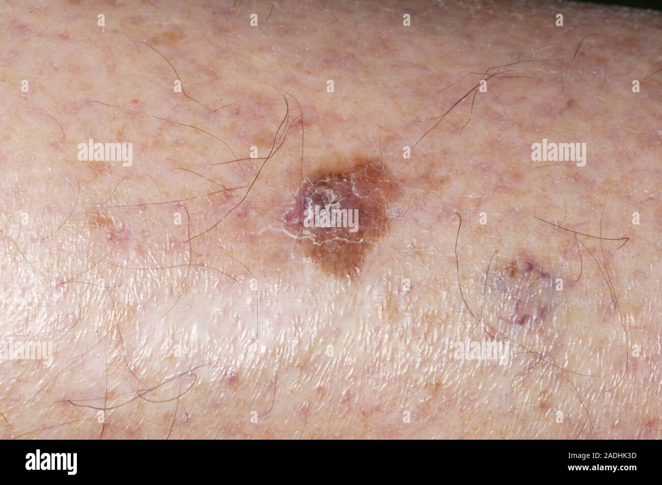MODEL RELEASED. Precancerous skin lesion on a 65- year-old man's shin ...
