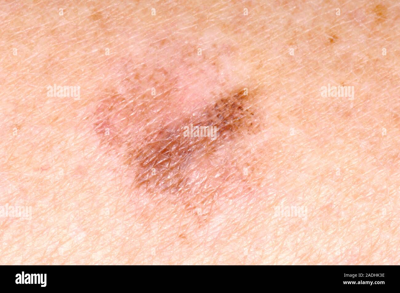 Pre-cancerous skin lesion on the thigh of a 56-year-old woman ...