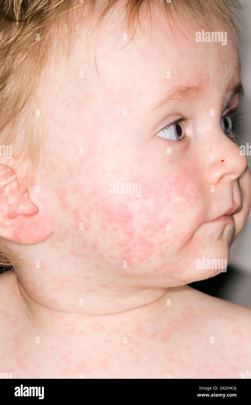 Measles rash on a 1 year old boy's face. Measles, also called morbilli ...