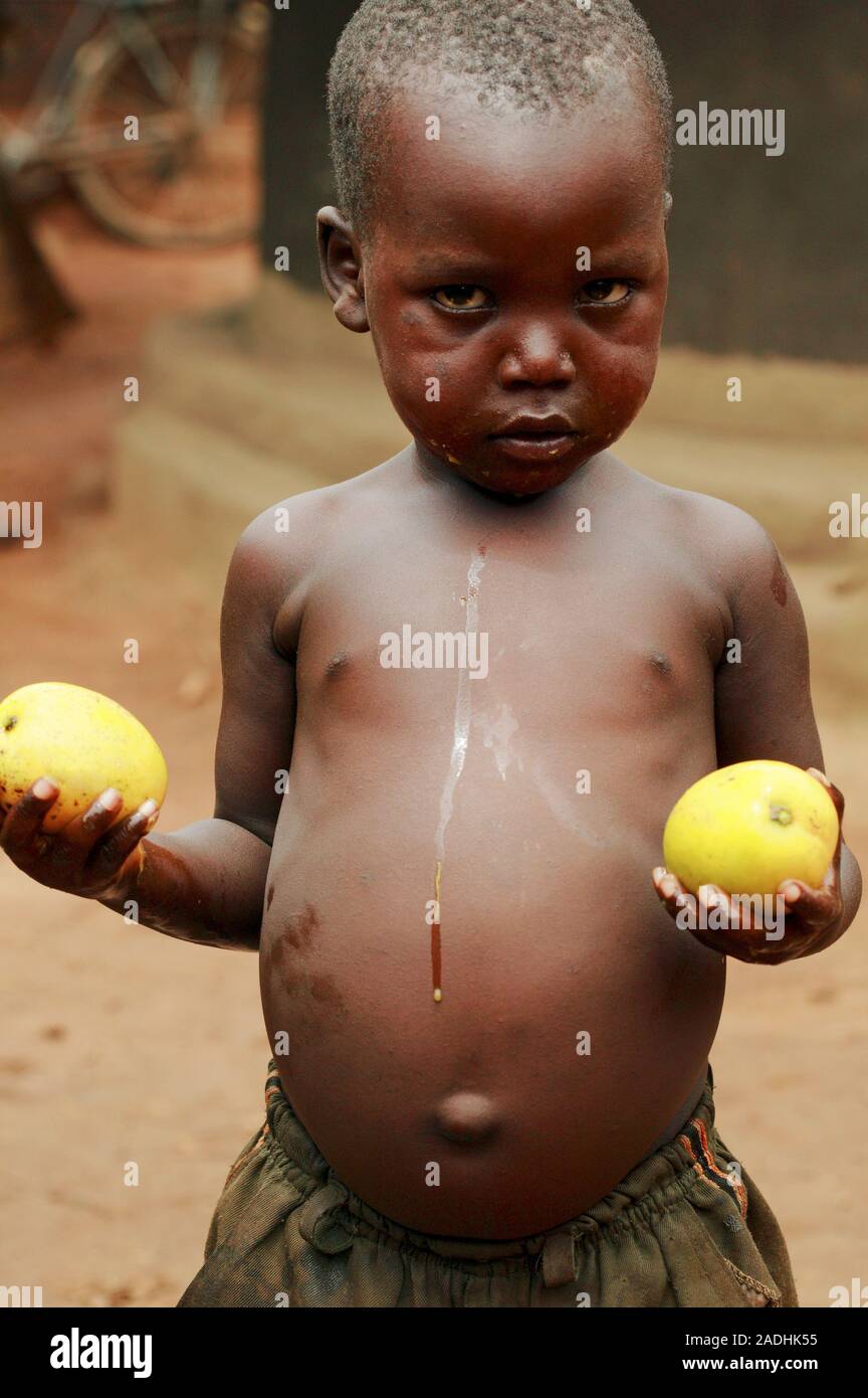Child holding two mango fruits (Mangifera sp.). The child's distended ...