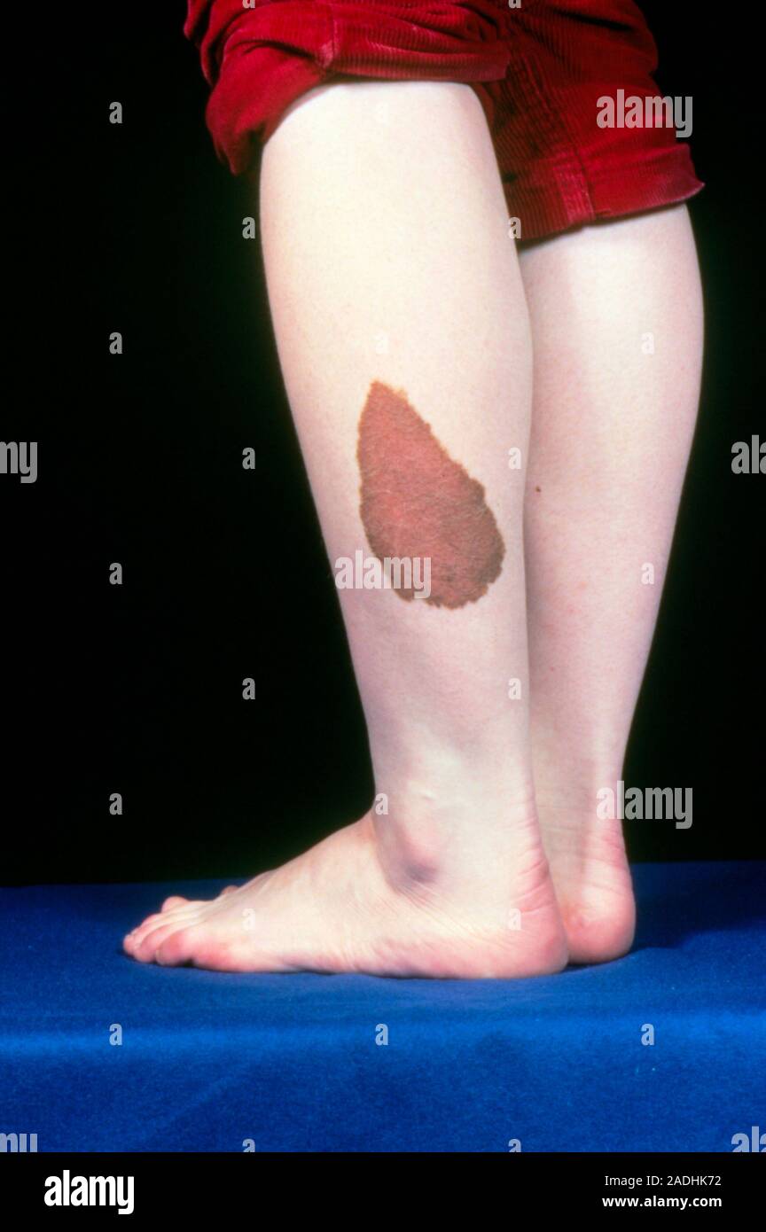 Large pigmented naevus (birthmark) on a young woman's calf. Naevi occur ...