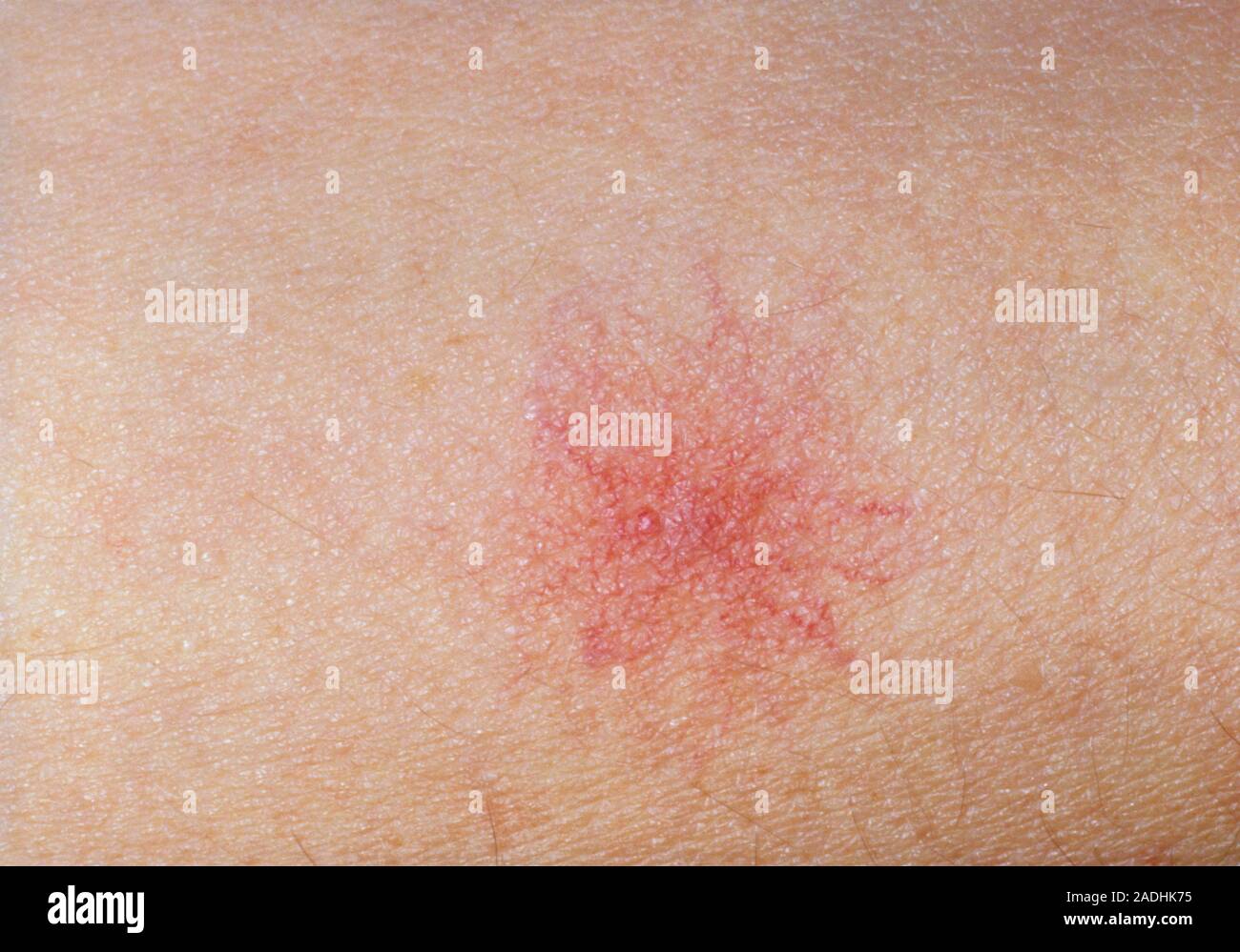 Spider naevus on the skin of a person's arm. In general, a naevus is a ...