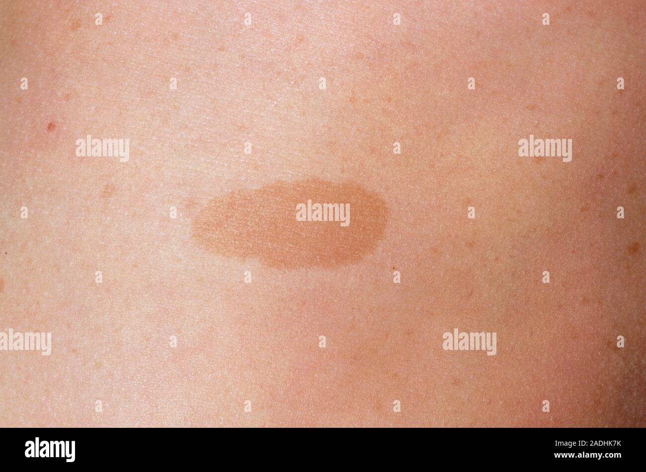 Cafe au lait skin pigmentation. Such coffee- coloured patches are seen ...