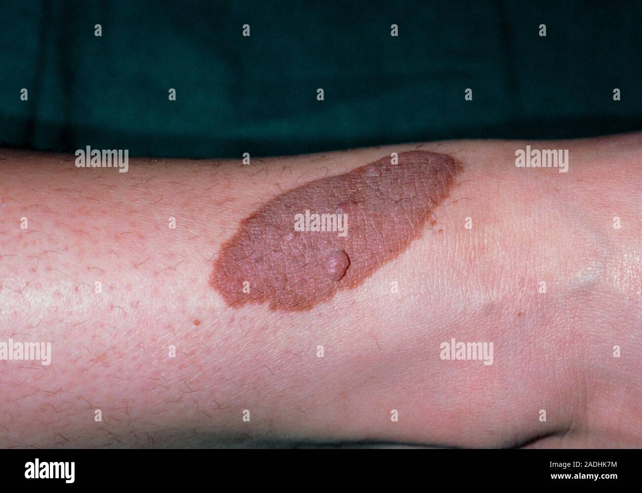Giant pigmented naevus or mole, a skin lesion caused by an abnormality ...