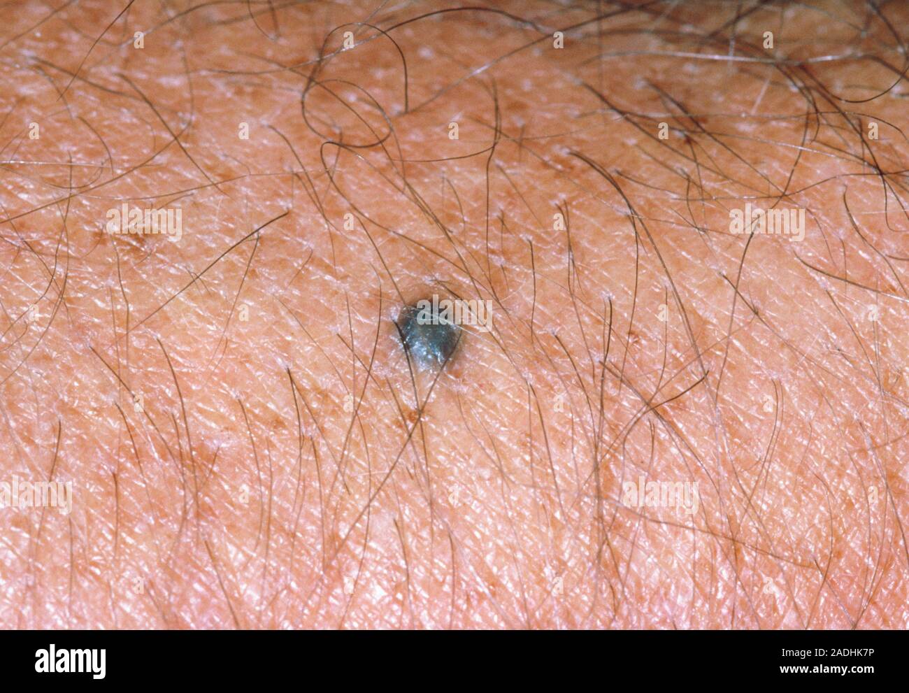 Close-up of a blue naevus, a harmless birthmark or mole composed of ...