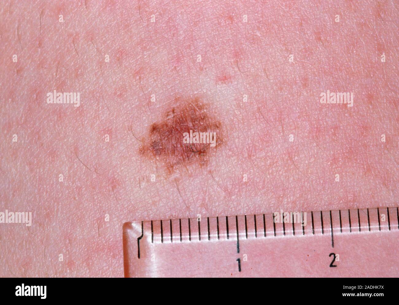 Intradermal naevus. A pigmented skin blemish, known as an intradermal ...