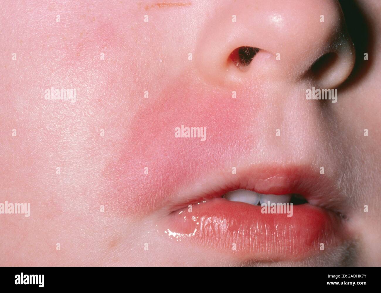 Port-wine stain. This birthmark (or cutaneous naevus) present above a ...