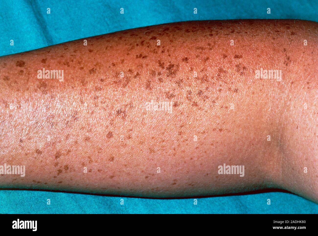 Skin disorder. Close-up of the arm of a patient showing many benign ...