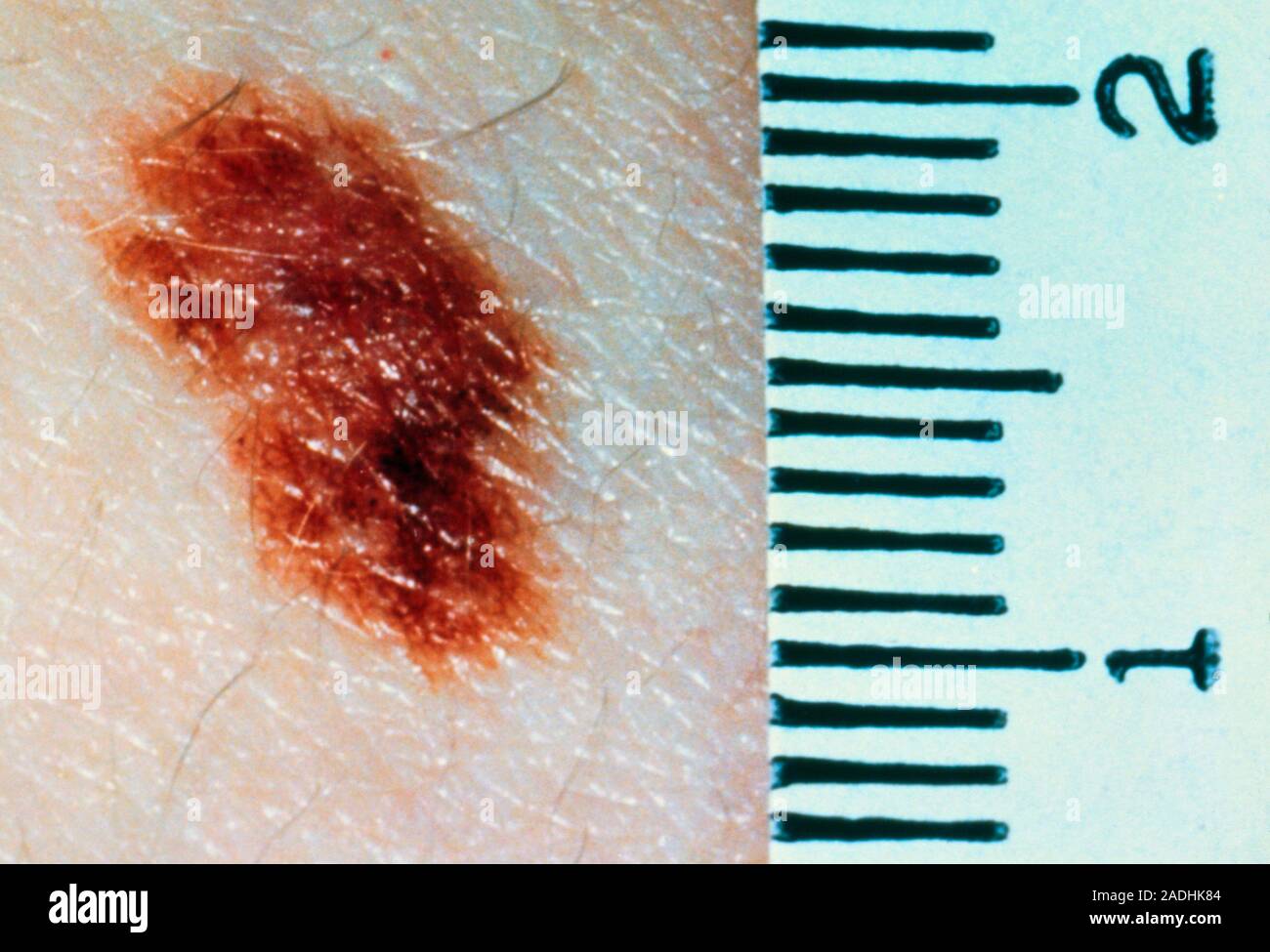 Precancerous naevus. Close-up of the skin of a patient showing a ...
