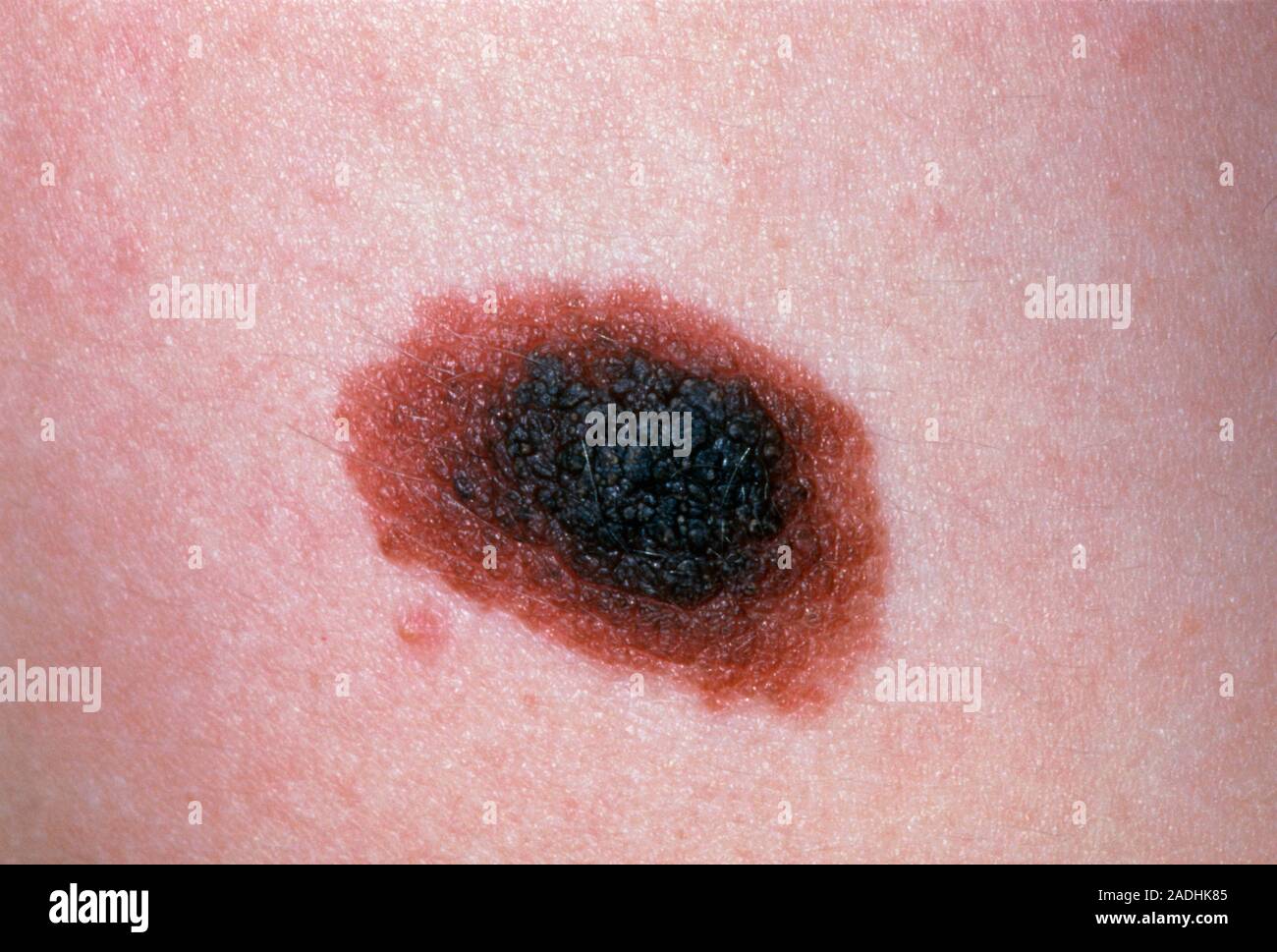 Congenital naevus. Close-up of dark brown raised birthmark or ...