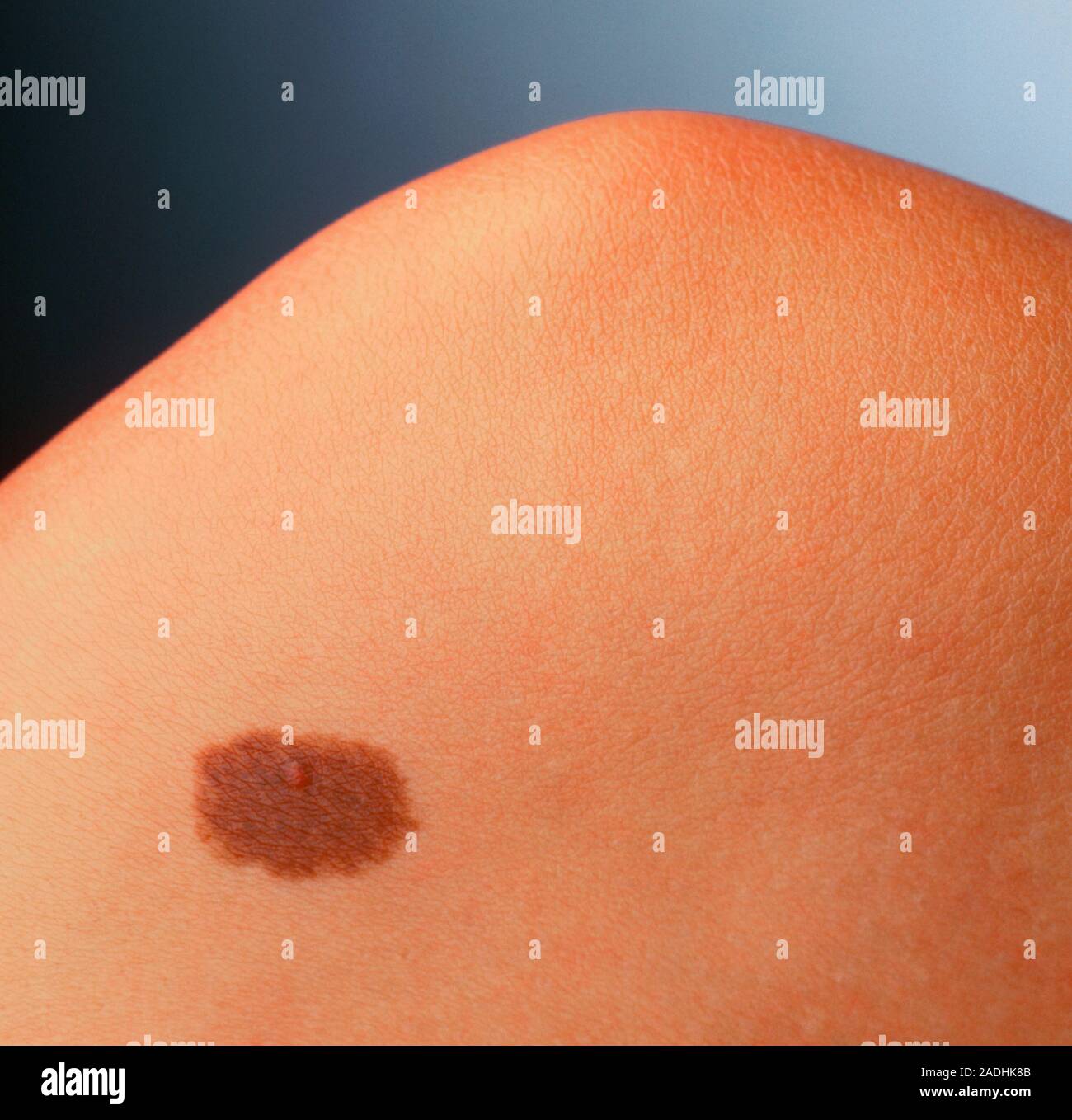 Benign mole. Close-up of a pigmented naevus, also known as a mole, near ...
