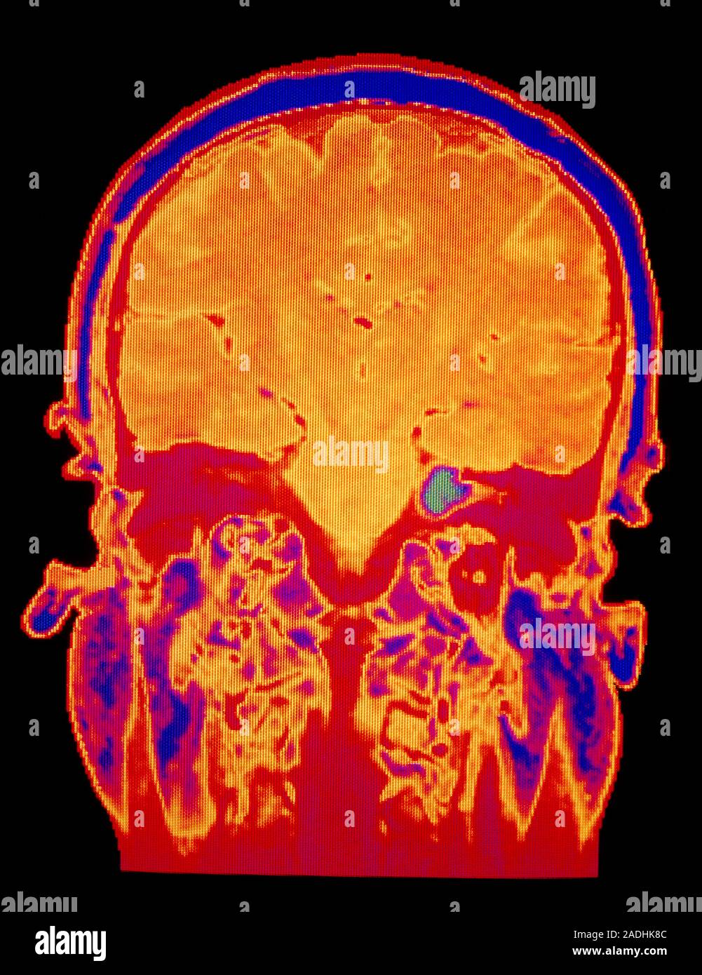 Acoustic neuroma: false-colour magnetic resonance image (MRI) scan of a ...